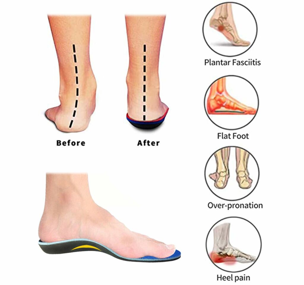 OrthoStride Orthotic Plantar Fasciitis Insoles for Arch Pain and High ...